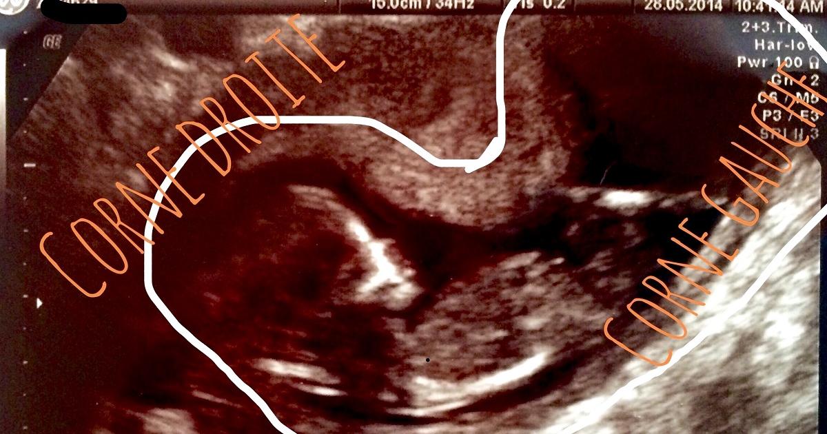 Mon petit utérus cornu | TPL Moms